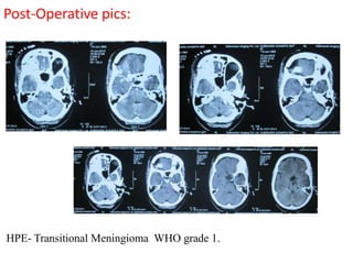 Supraorbital craniotomy. | PPTX