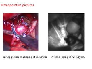 Supraorbital craniotomy. | PPTX