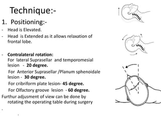 Supraorbital craniotomy. | PPTX