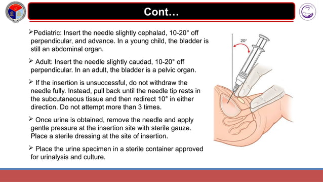 How to perform Suprapubic Aspiration.pptx