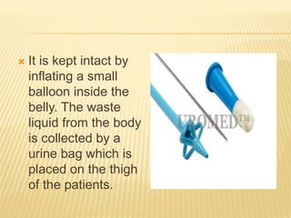 Suprapubic catheters | PPT