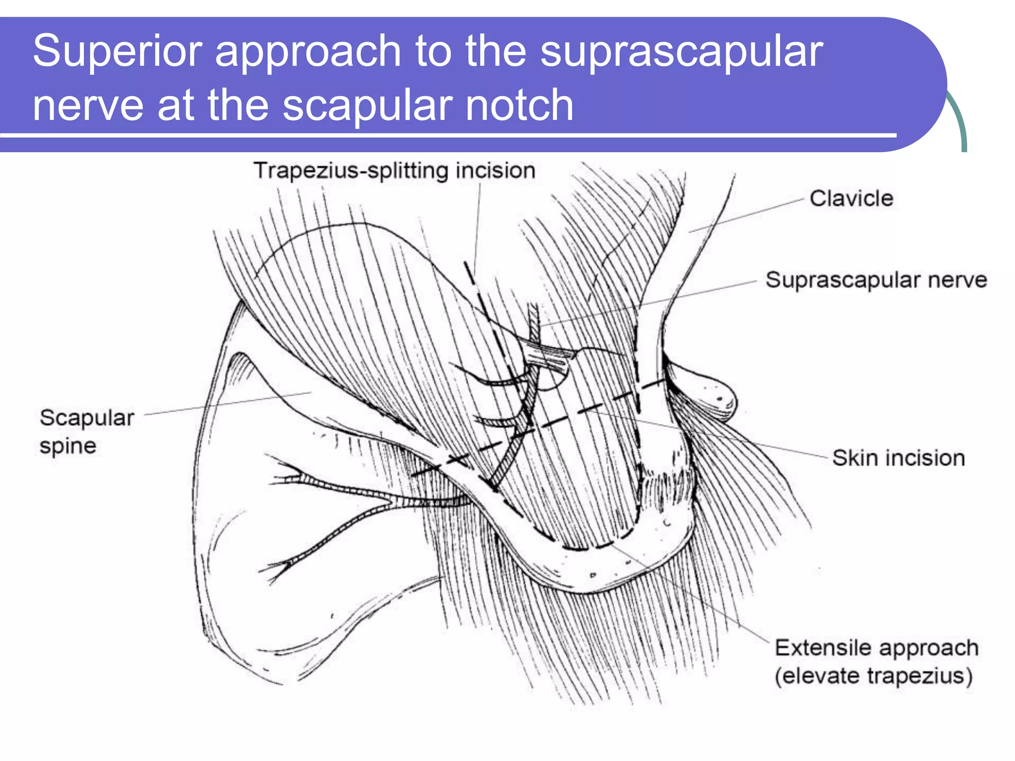Suprascapular nerve entrapment | PPT
