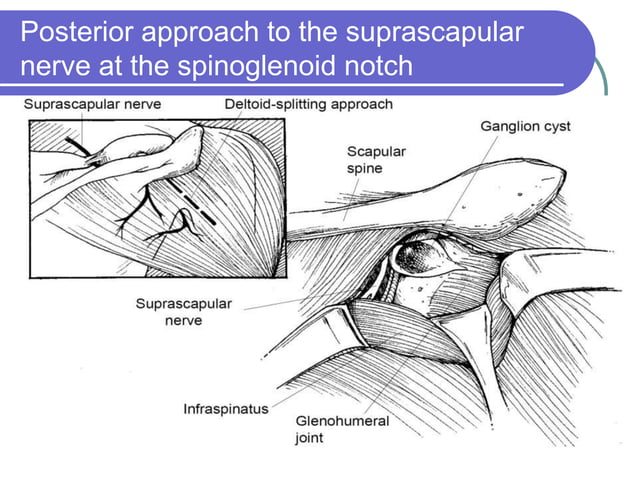 Suprascapular nerve entrapment | PPT