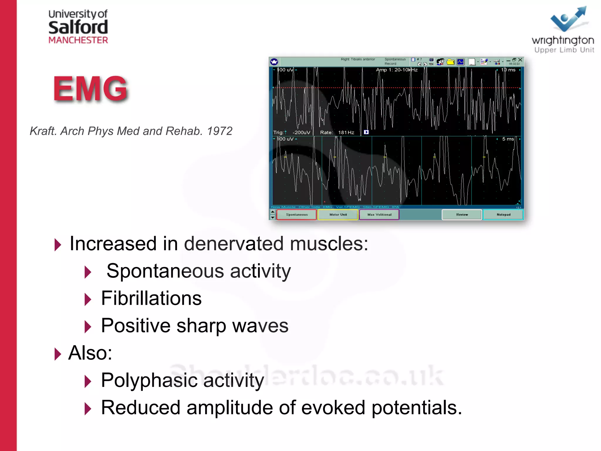 Suprascapular Nerve Palsy - Lennard Funk 2015 | PDF