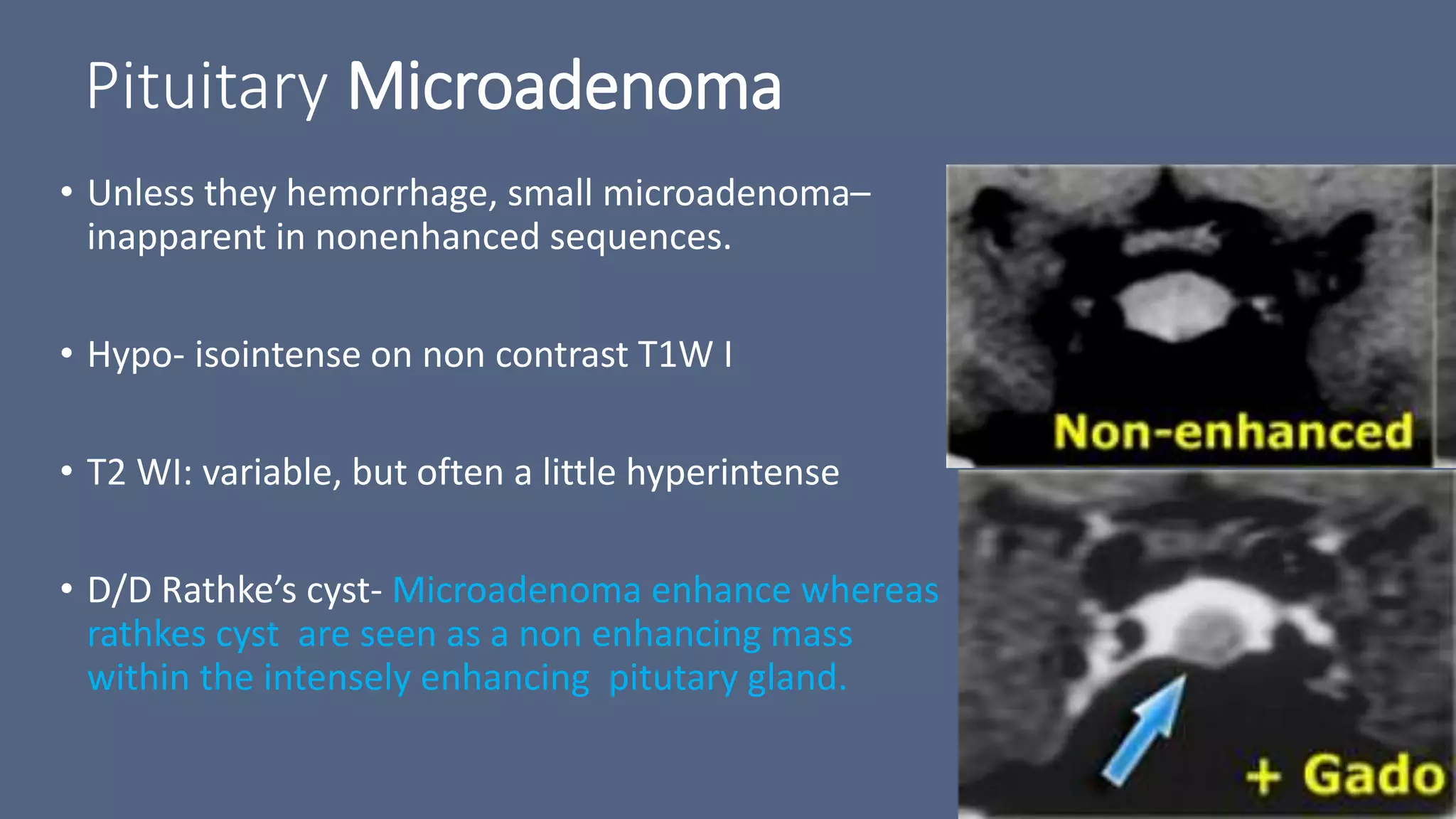 Sellar, Suprasellar and Pineal tumor final pk .ppt