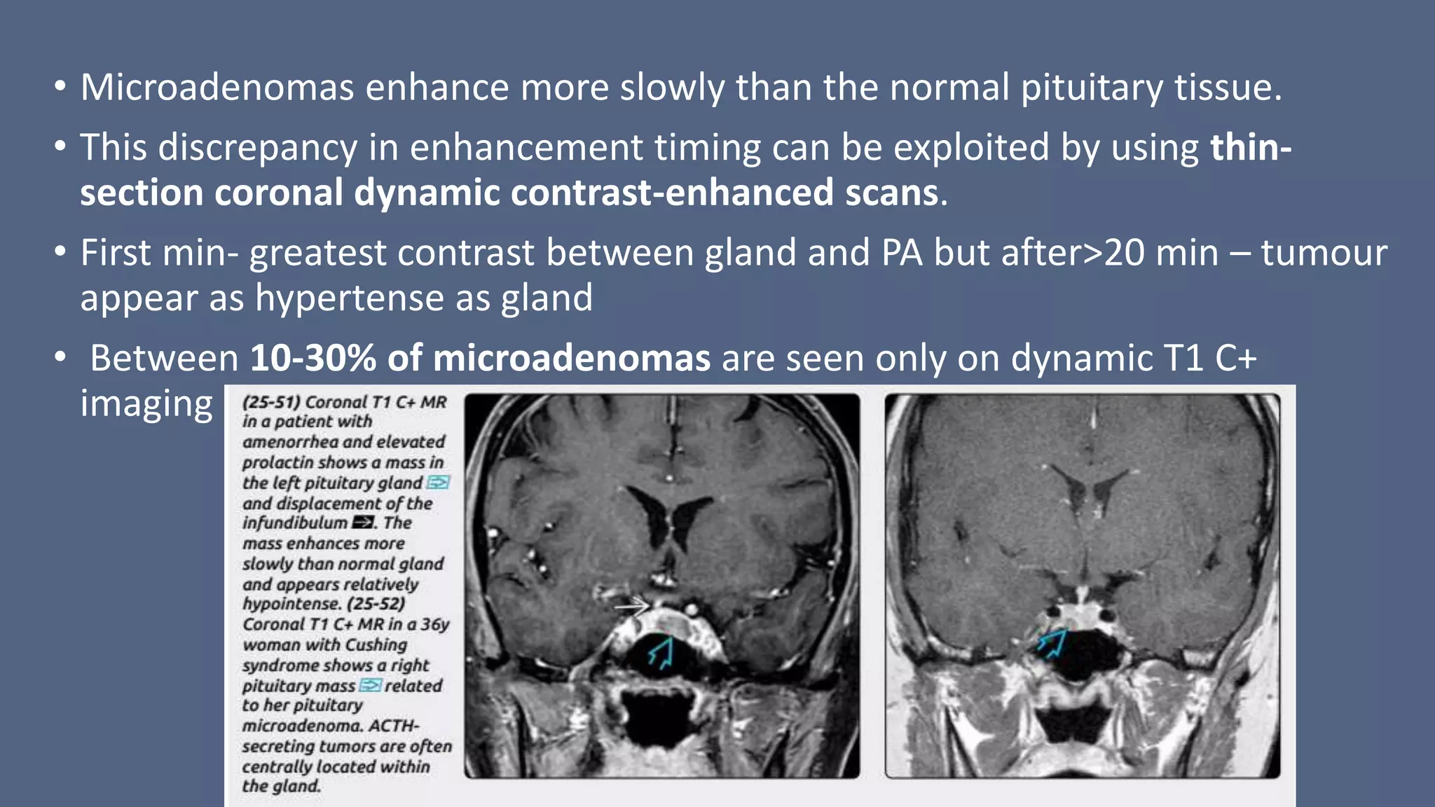 Sellar, Suprasellar and Pineal tumor final pk .ppt