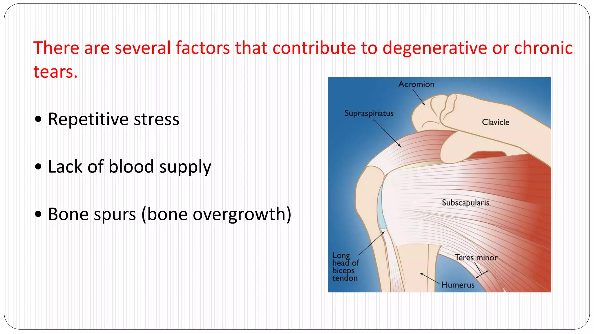 Supraspinatus tear - medial information | PPTX