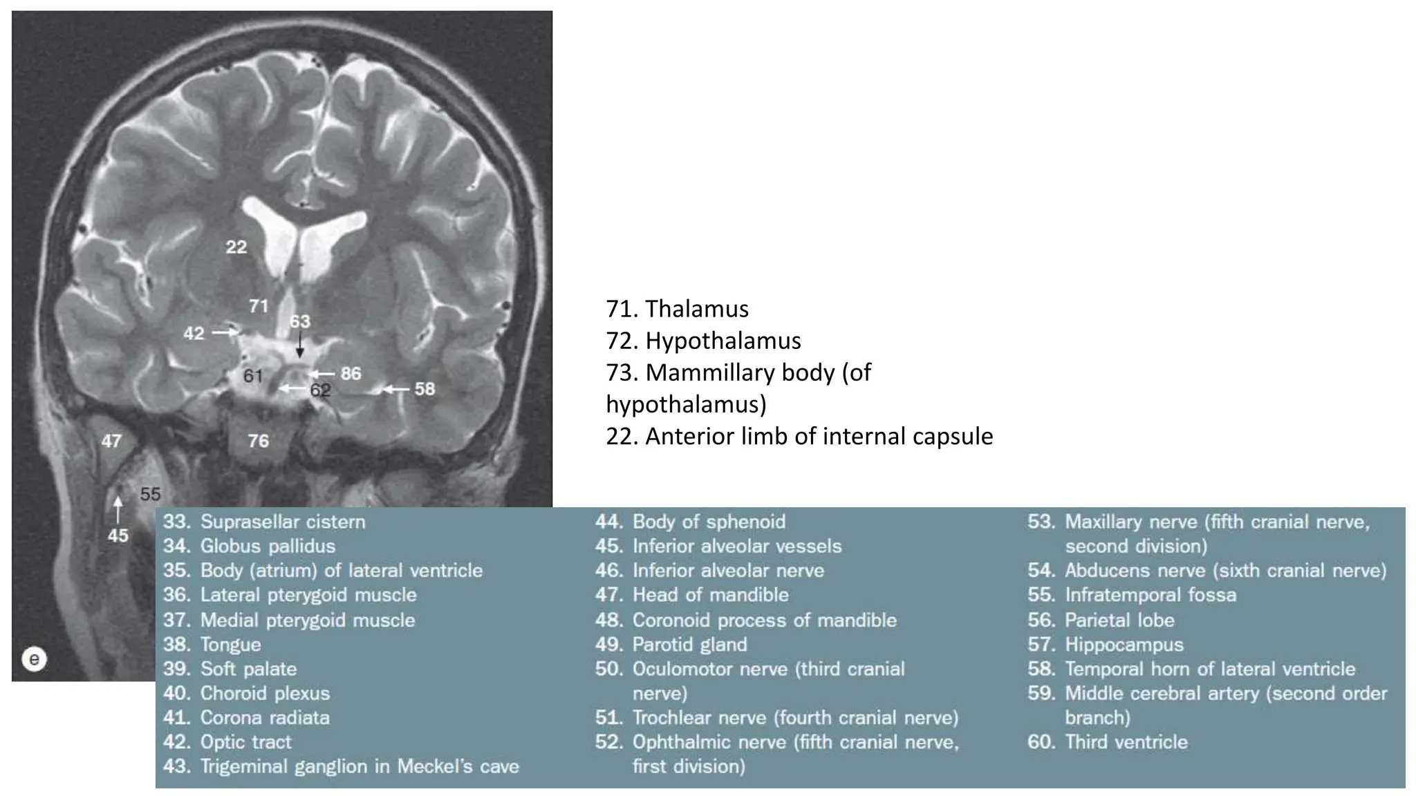 supratentorial area Imaging presantation.pptx