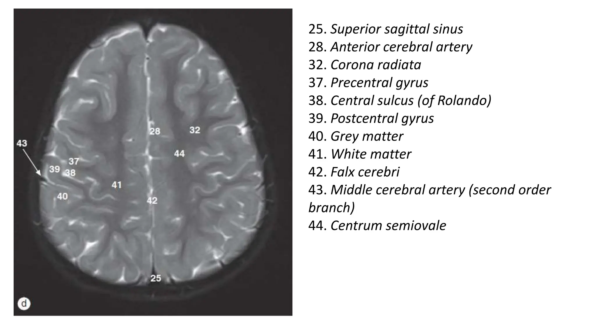 supratentorial area Imaging presantation.pptx