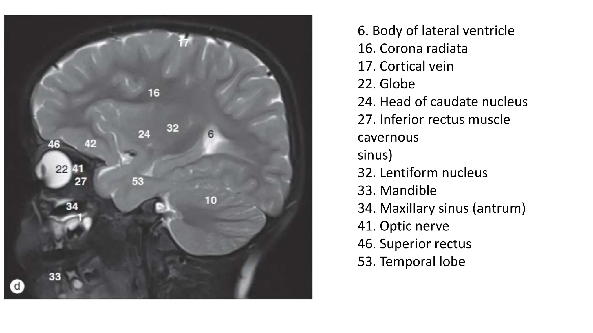 supratentorial area Imaging presantation.pptx
