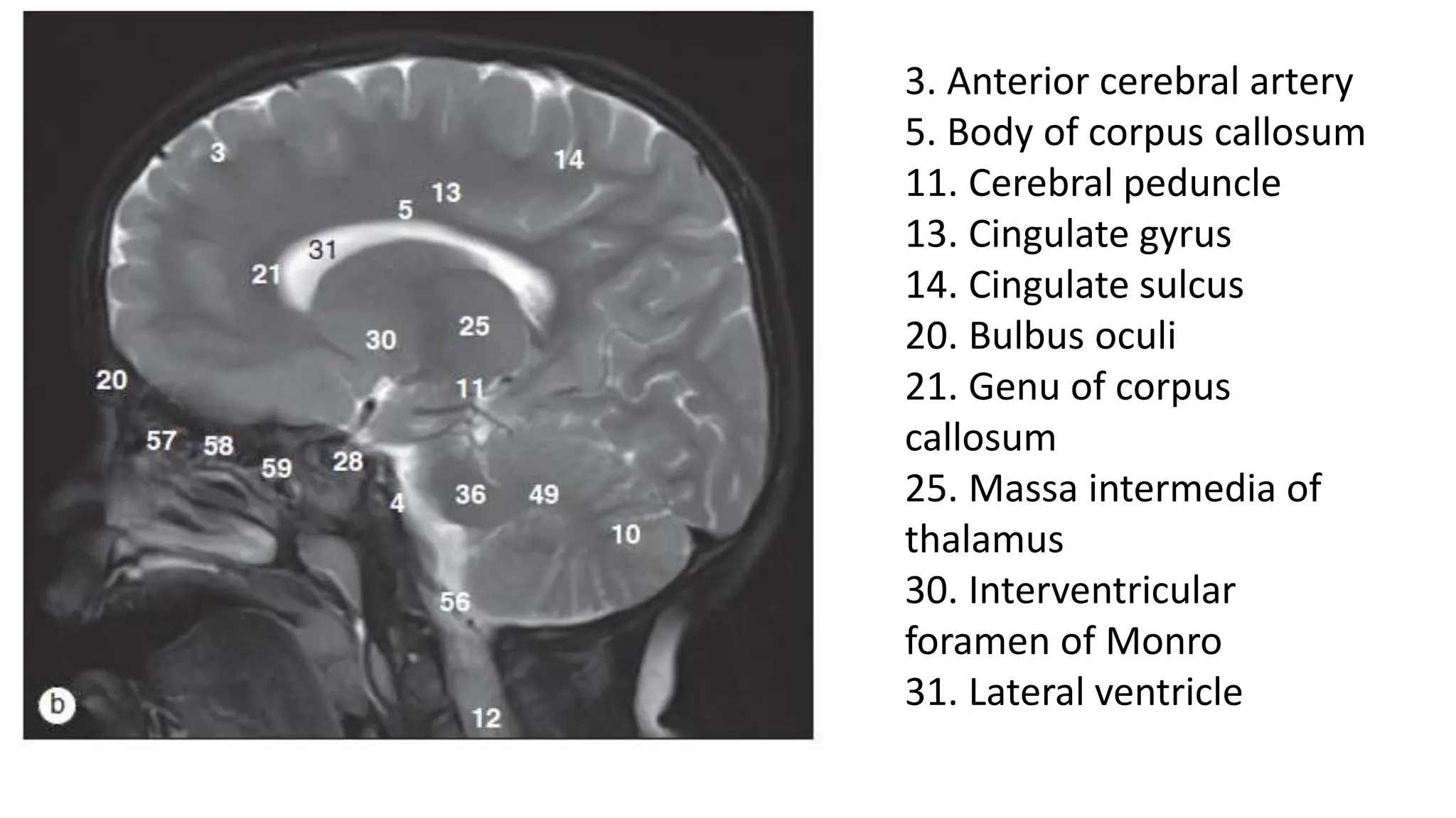 supratentorial area Imaging presantation.pptx
