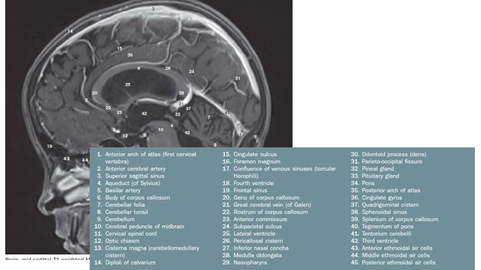 supratentorial area Imaging presantation.pptx