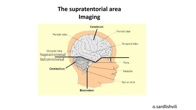 supratentorial area Imaging presantation.pptx