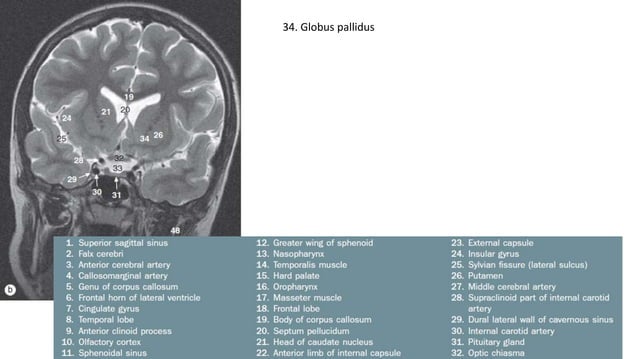 supratentorial area Imaging presantation.pptx