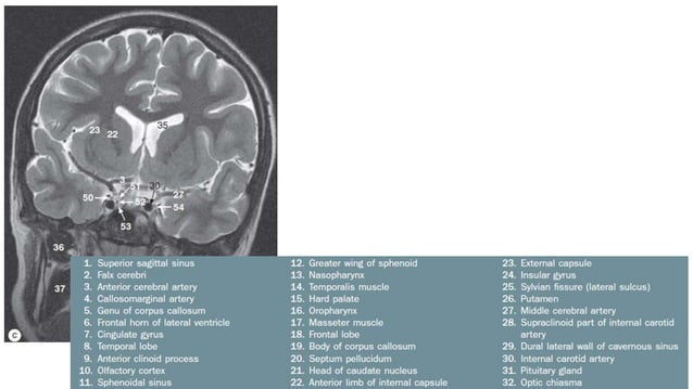 supratentorial area Imaging presantation.pptx