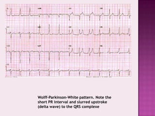 Supraventricular tacchycardias | PPTX
