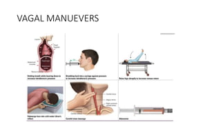 supraventricular tachyarrythmias on the go .pptx