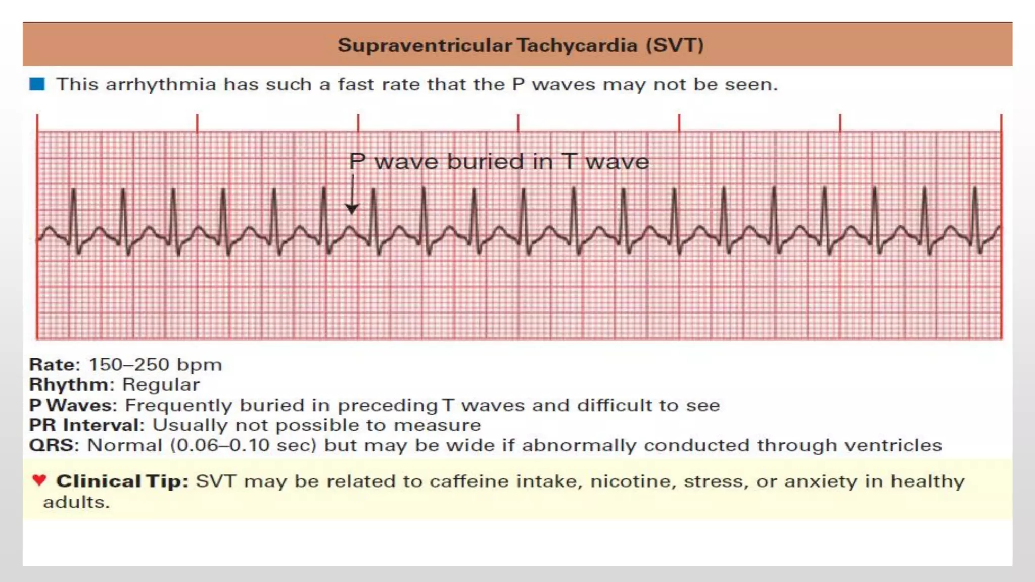 SVT | PDF