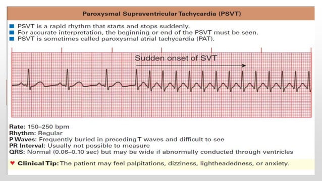 SVT | PDF | Heart and Cardiovascular Diseases | Diseases and Conditions