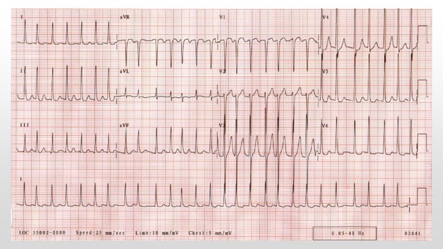SVT | PDF | Heart and Cardiovascular Diseases | Diseases and Conditions