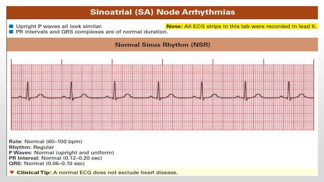 SVT | PDF | Heart and Cardiovascular Diseases | Diseases and Conditions
