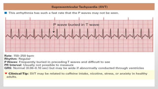 SVT | PDF