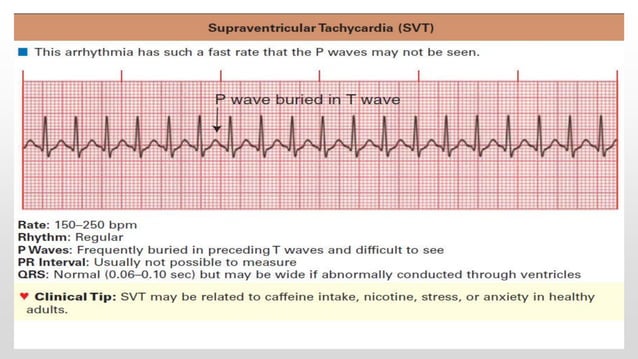 SVT | PDF | Heart and Cardiovascular Diseases | Diseases and Conditions