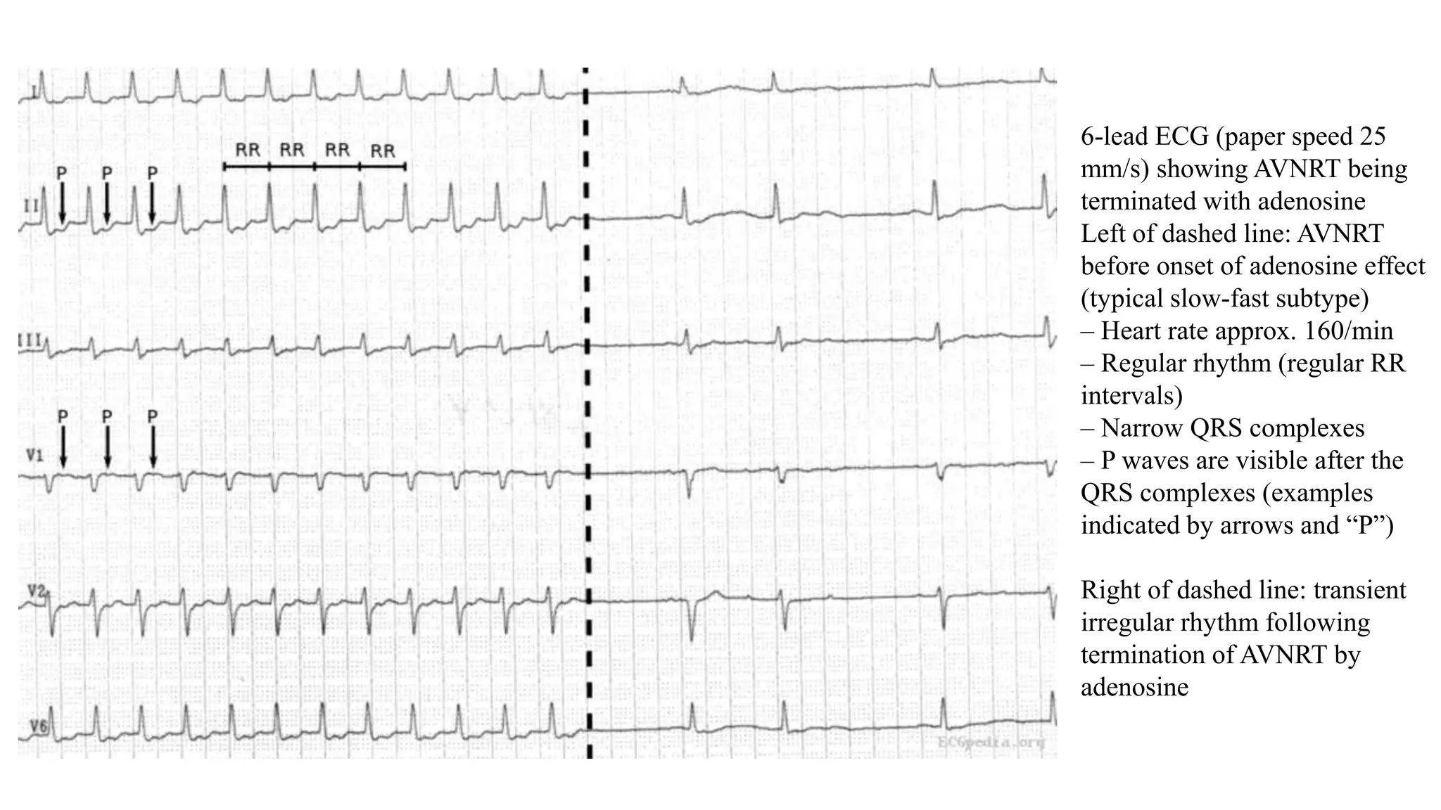 SupraventricularTachycardia.pptx
