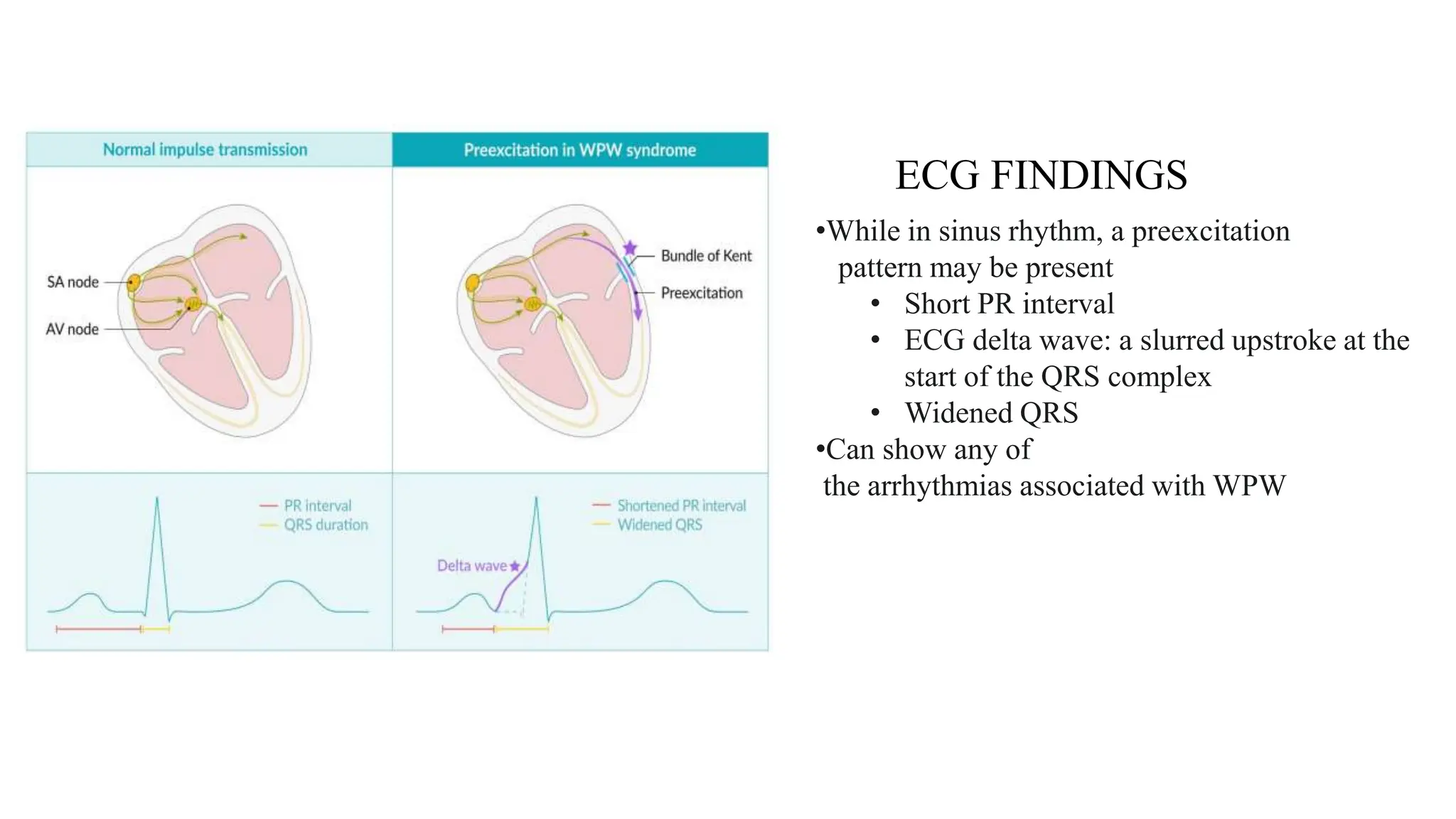SupraventricularTachycardia.pptx
