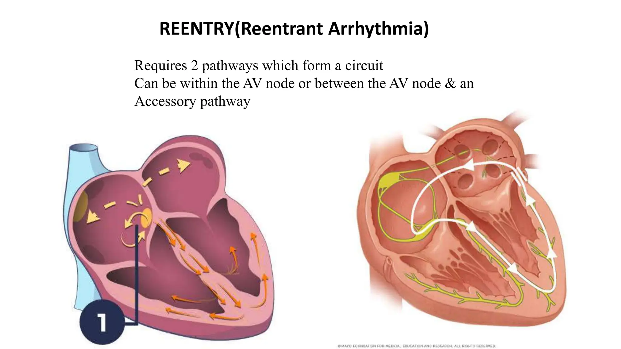 SupraventricularTachycardia.pptx