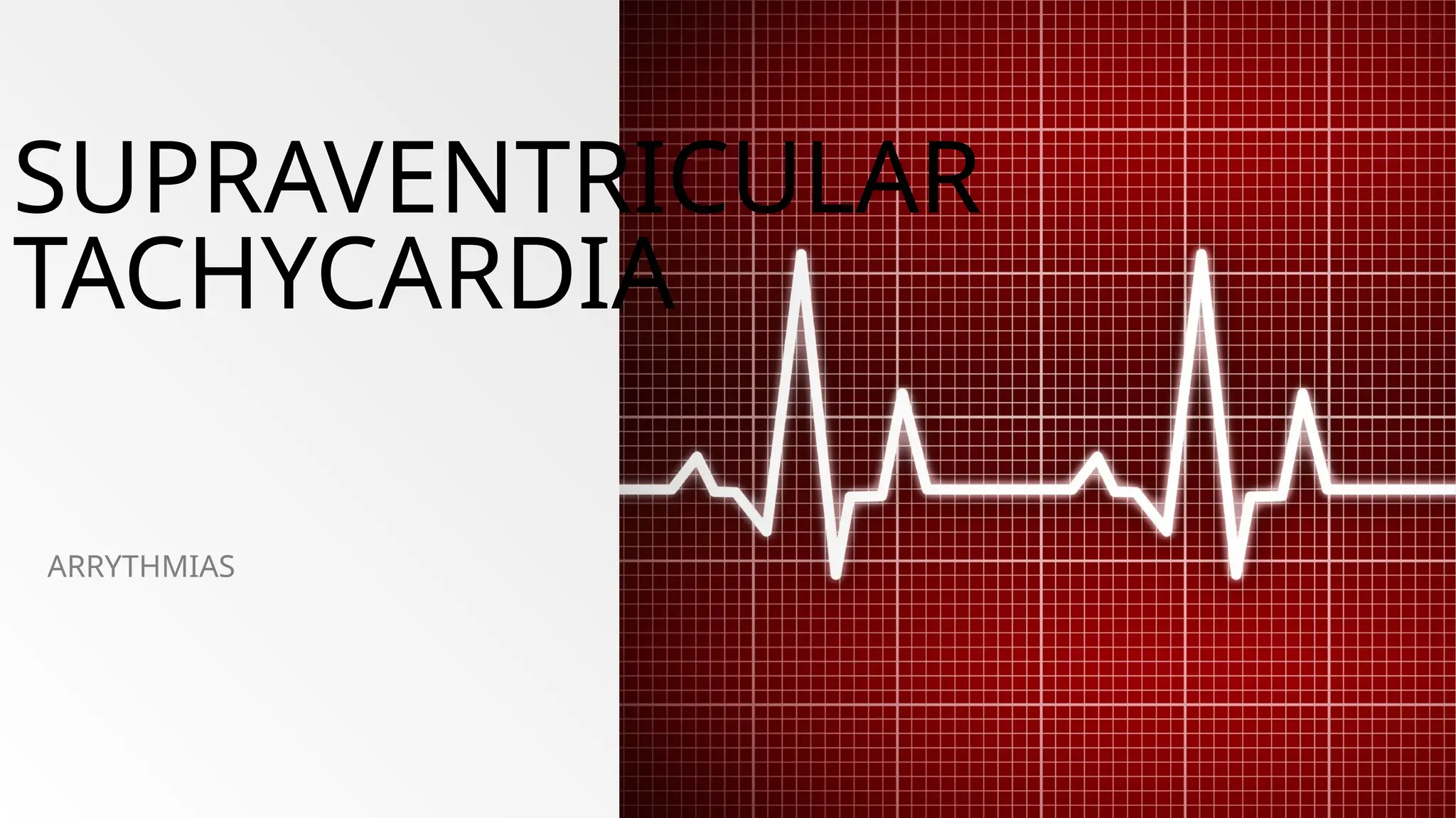 SUPRAVENTRICULAR TACHYCARDIA.pptx Slideshare | PPTX