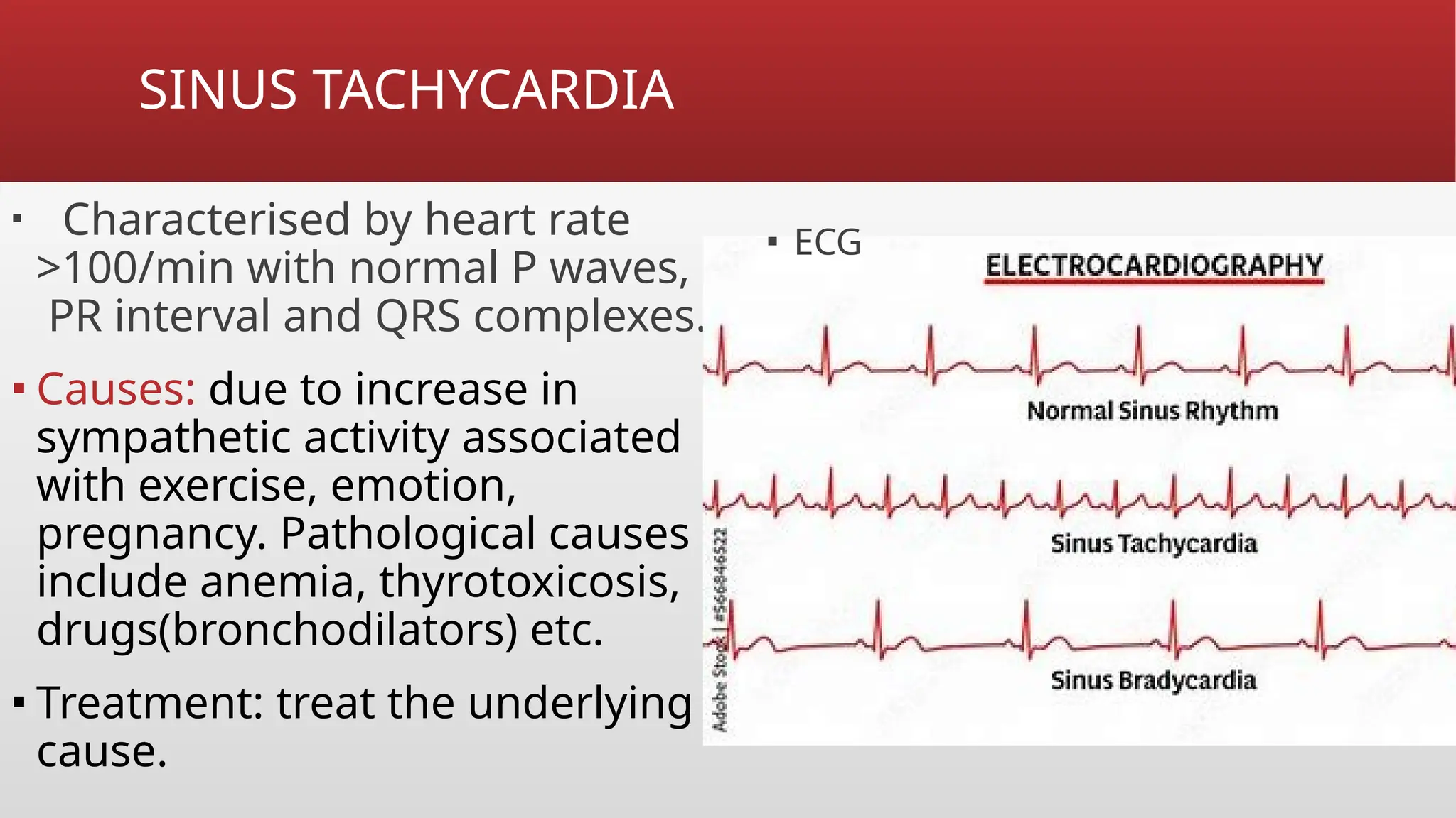 SUPRAVENTRICULAR TACHYCARDIA.pptx Slideshare | PPTX