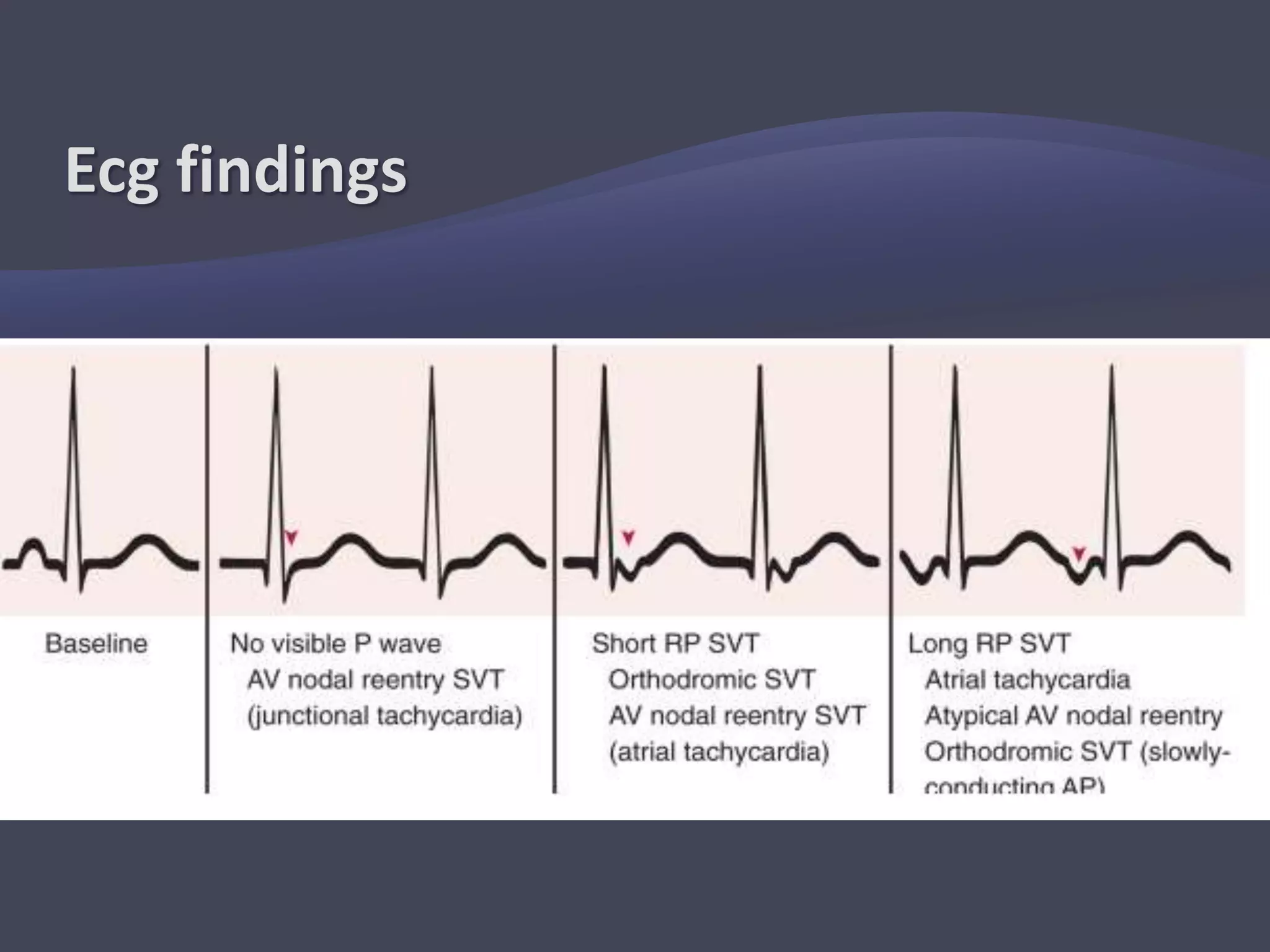 Supraventricular tachycardias | PPTX