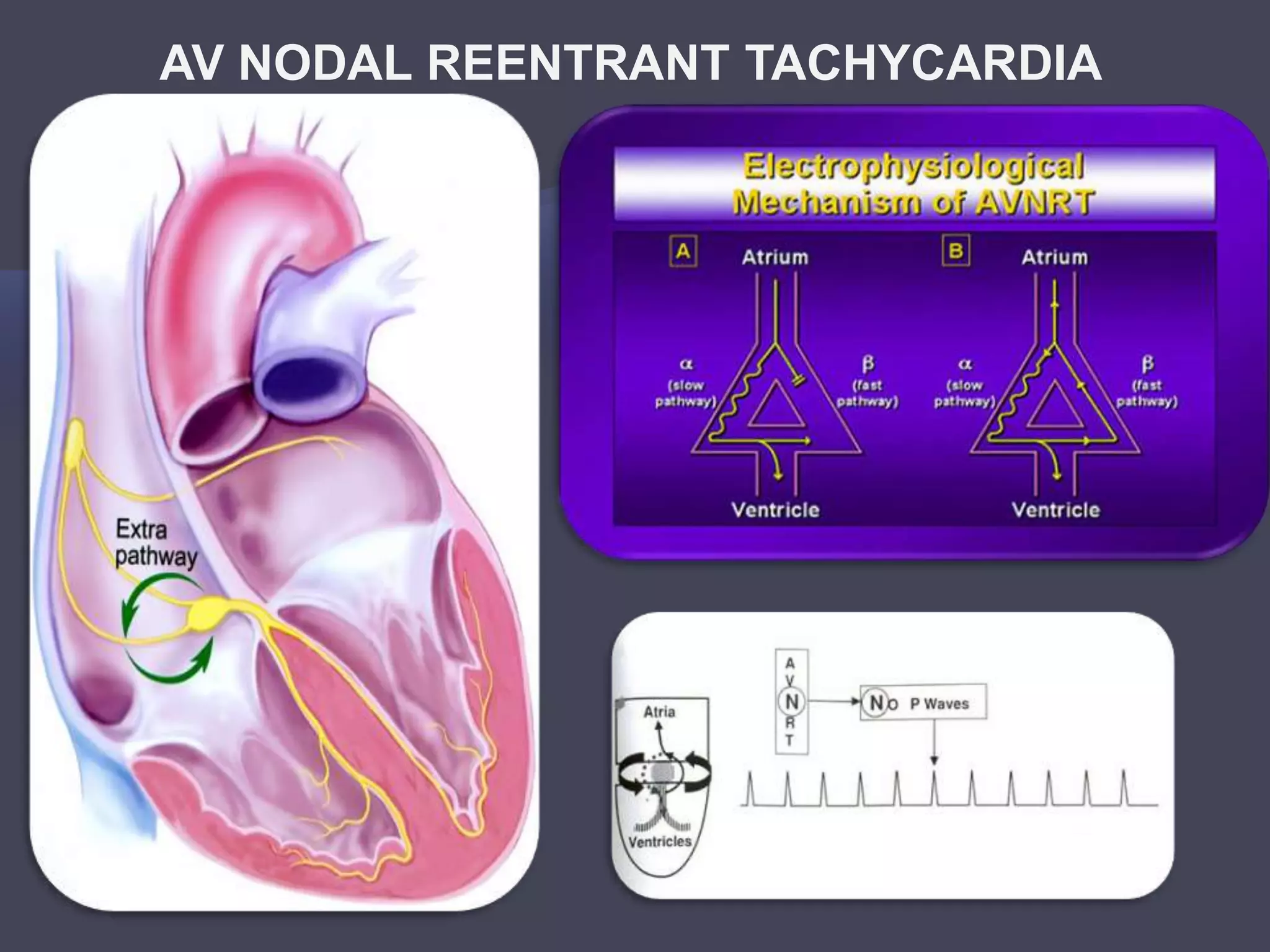 Supraventricular tachycardias | PPTX