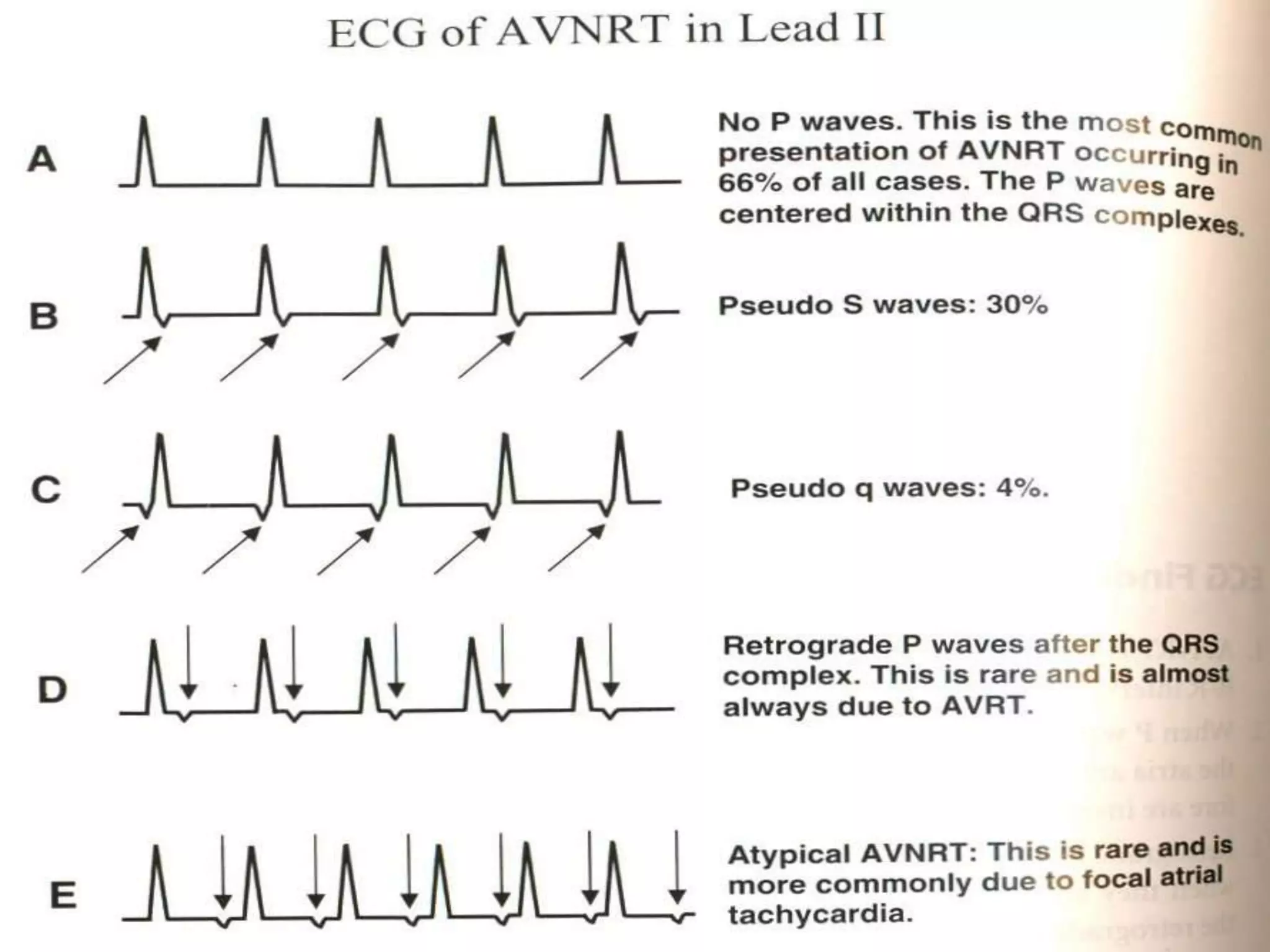 Supraventricular tachycardias | PPTX
