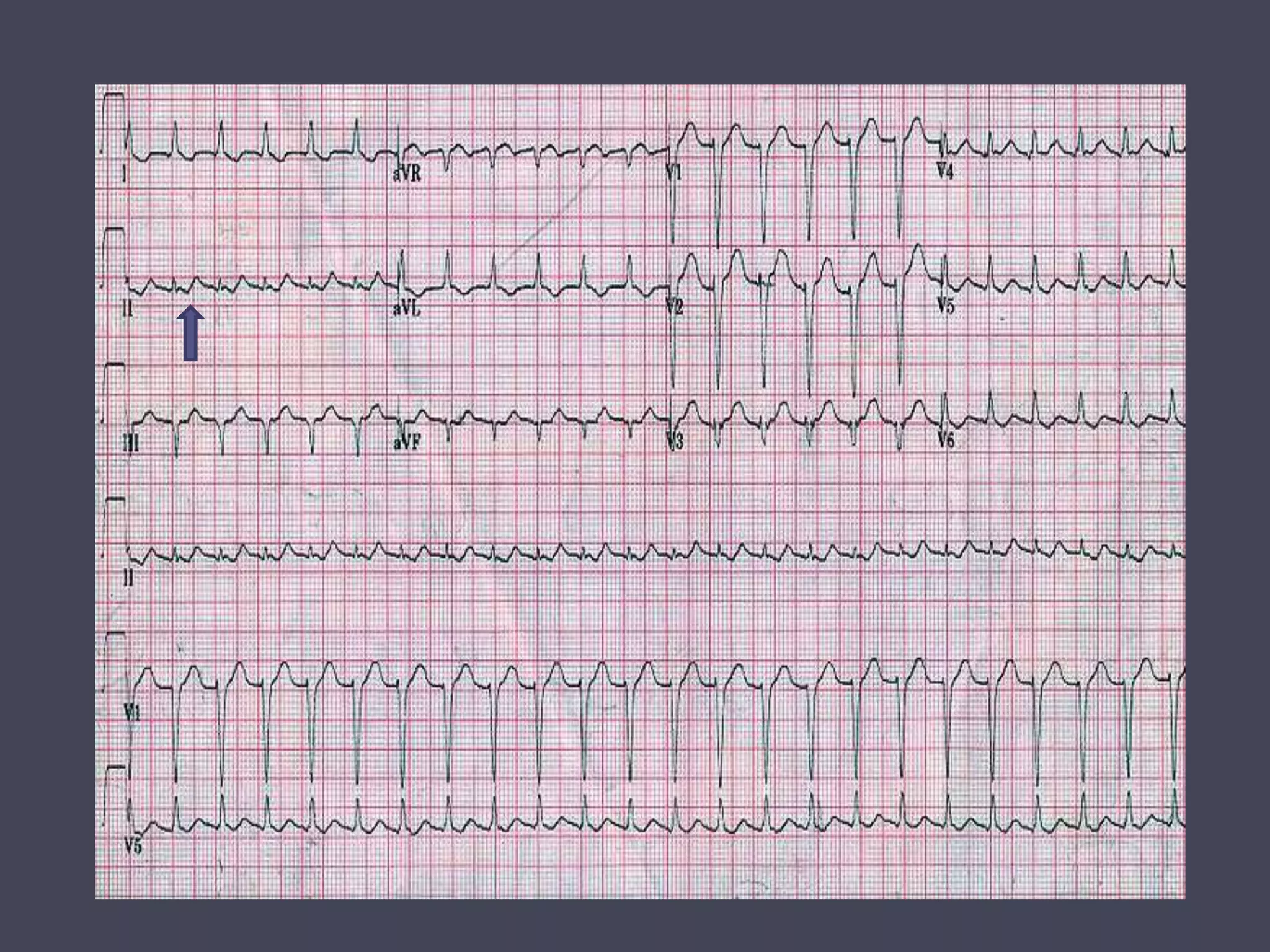Supraventricular tachycardias | PPTX