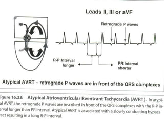 Supraventricular tachycardias | PPT