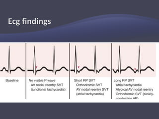 Pediatric Svt Ecg