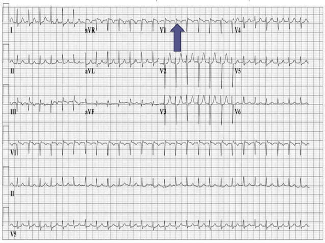 Ventricular Tachycardia Rvot Vt Right Ecg Tract Outflow Originating ...