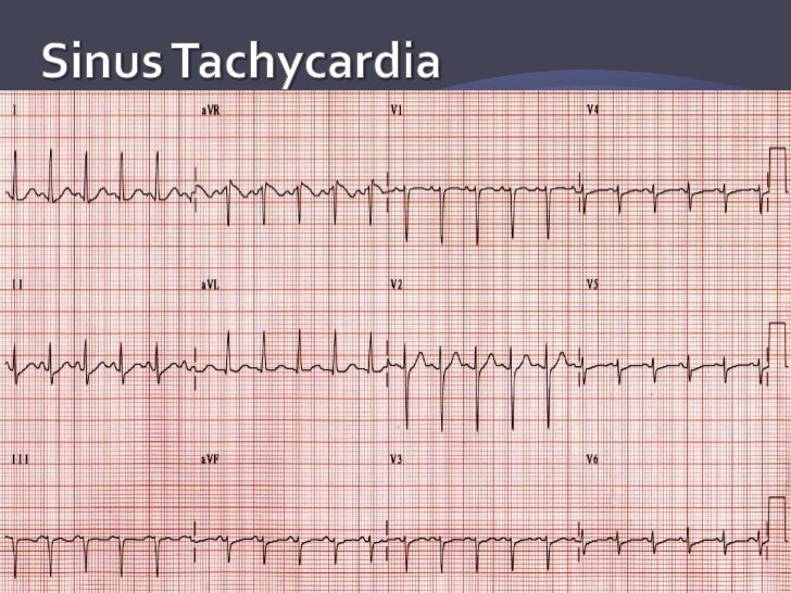 Reentry Supraventricular Tachycardia Vs Sinus Tachycardia Ecg Avnrt