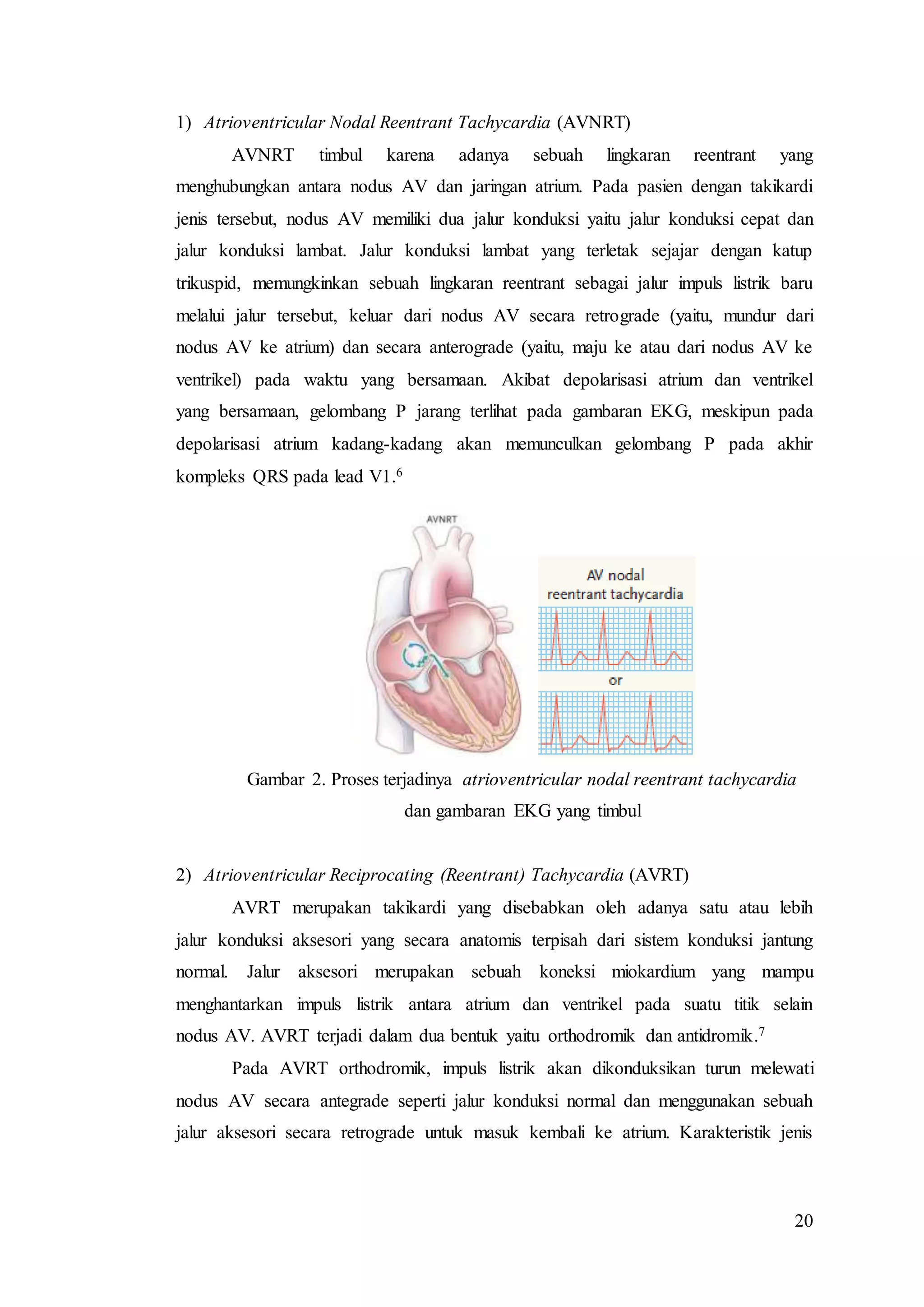 Supraventrikuler takikardi | DOCX