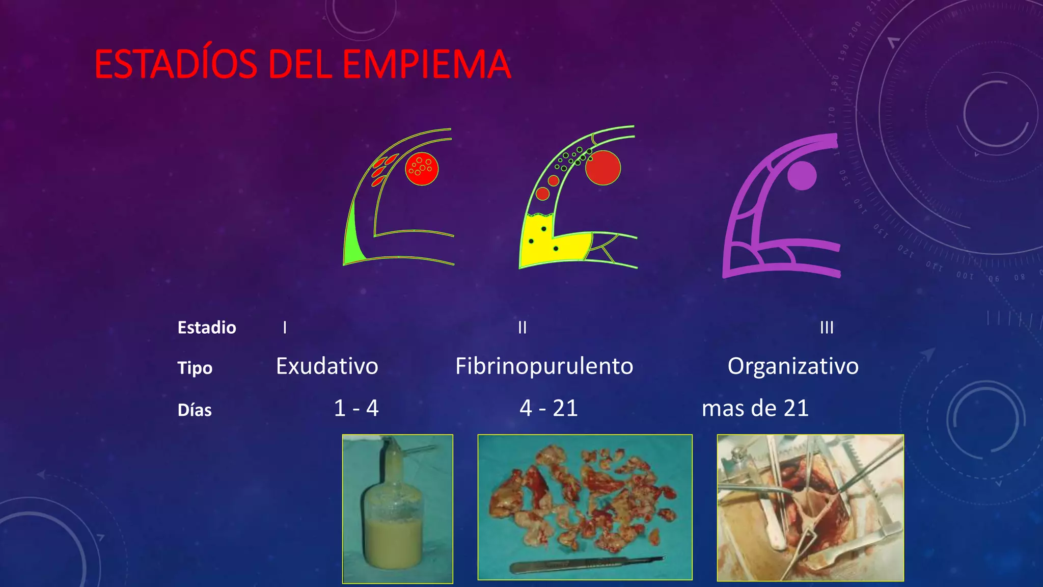 Supuraciones pleuropulmonares | PPT