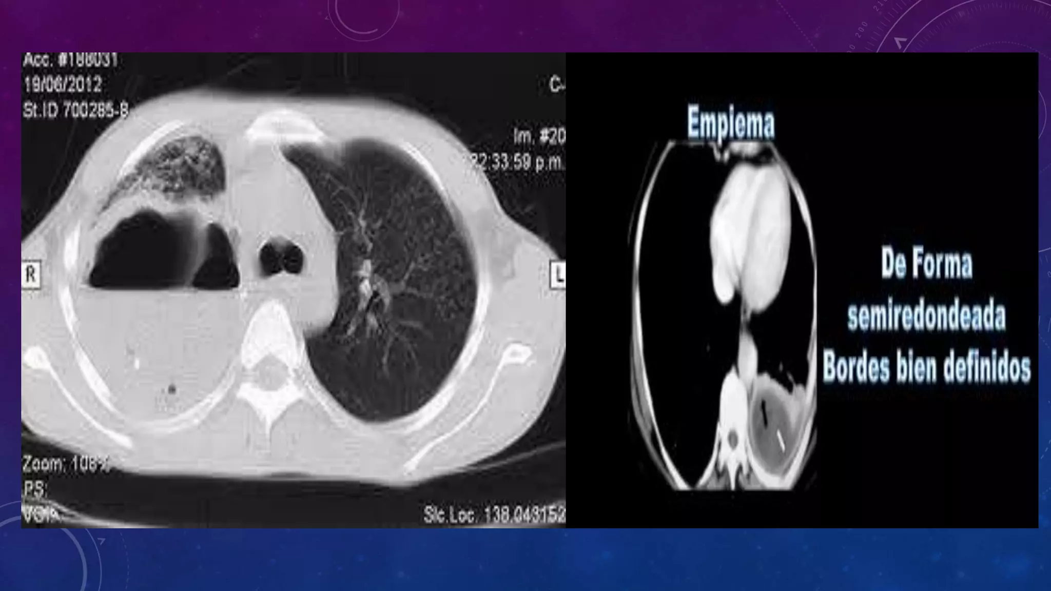 Supuraciones pleuropulmonares | PPT