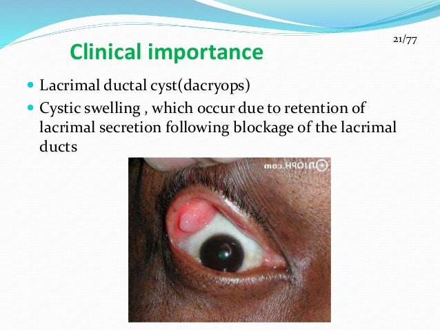 Suraj ..lacrimal appartus ppt (2)