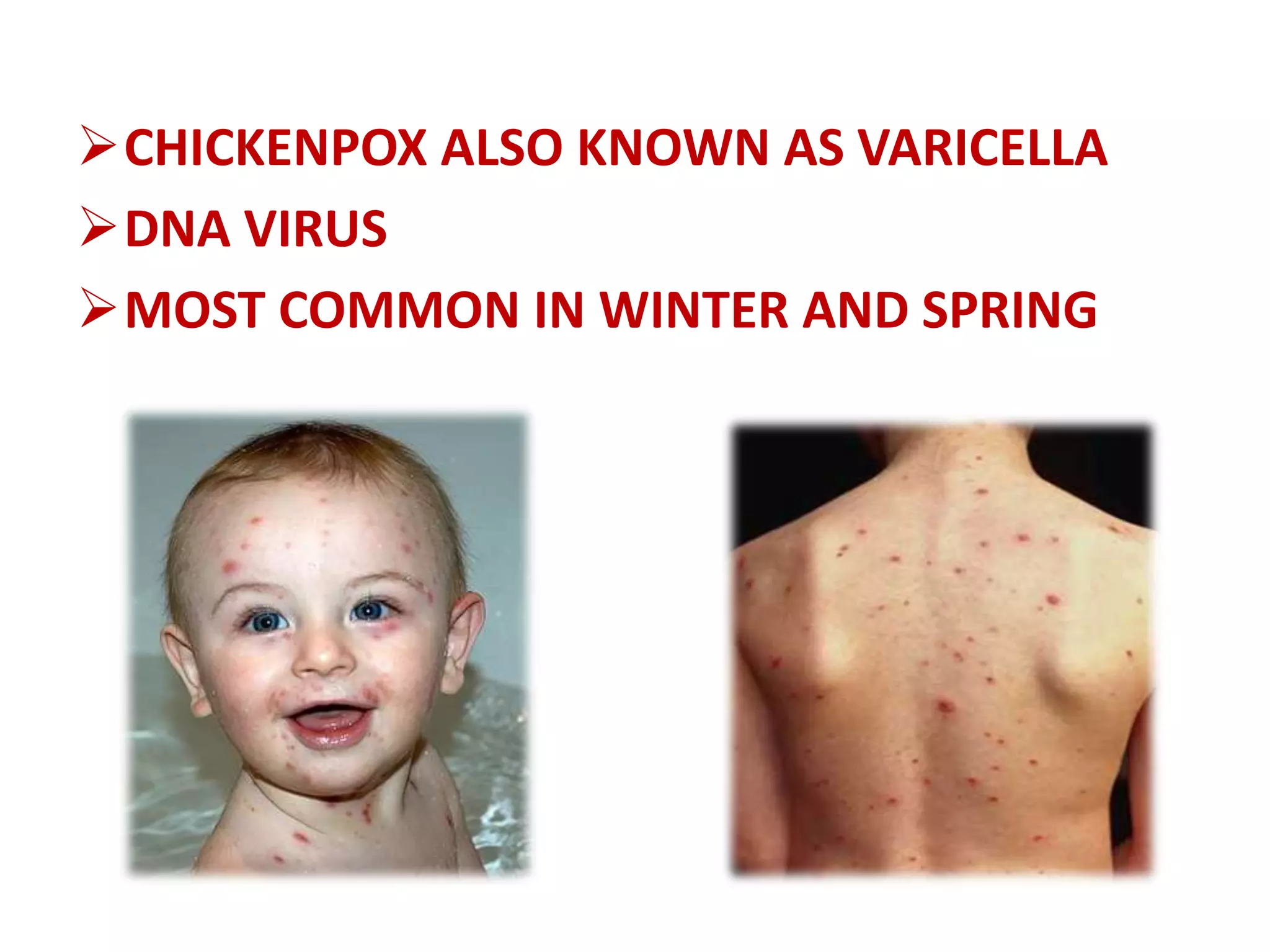 CHICKENPOX ppt | PPTX
