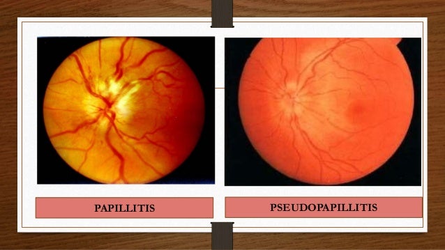 Hypermetropia/Hyperopia