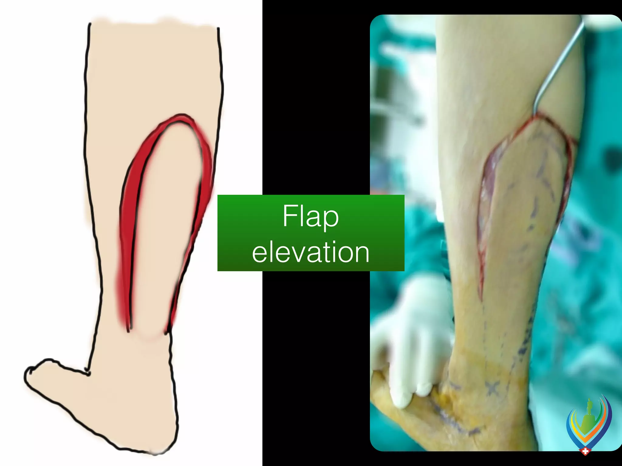 Distally-Based Sural Flap | PDF