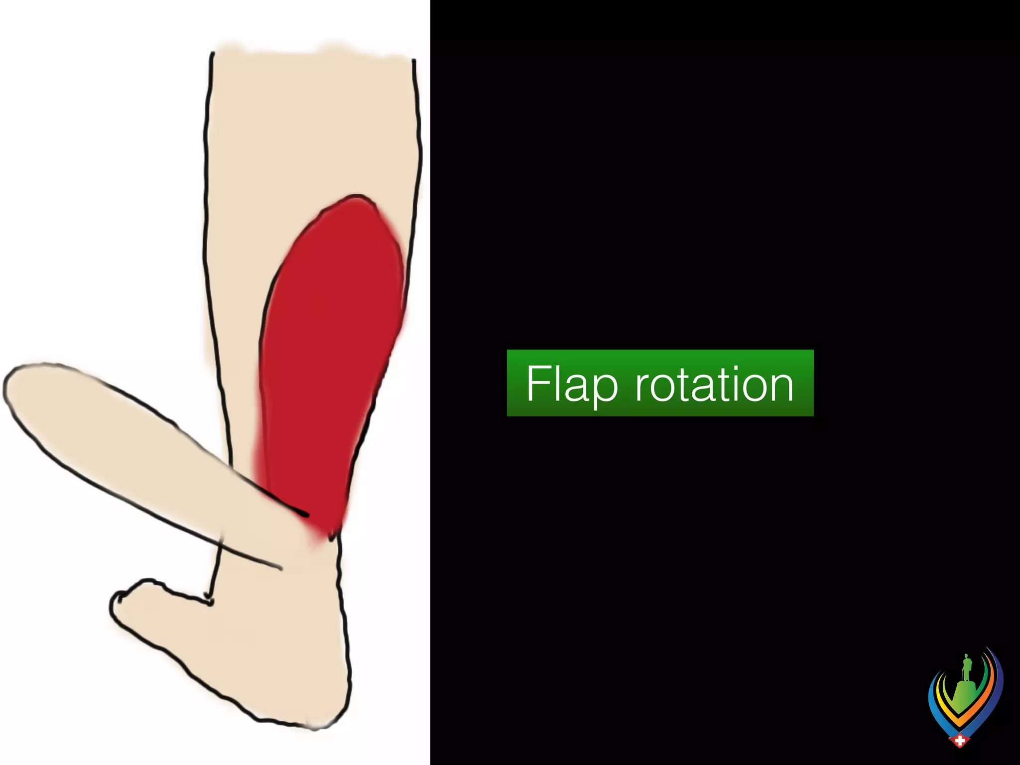 Distally-Based Sural Flap | PPT