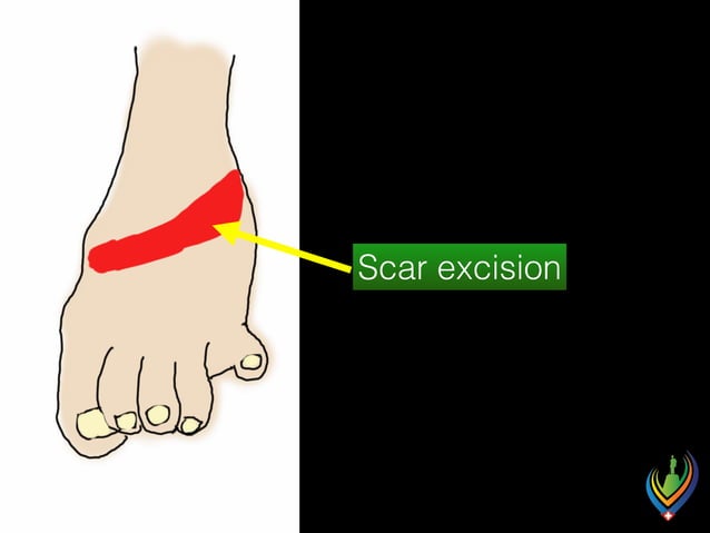 Distally-Based Sural Flap | PDF