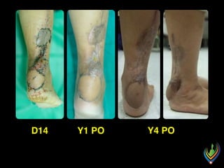Distally-Based Sural Flap | PDF